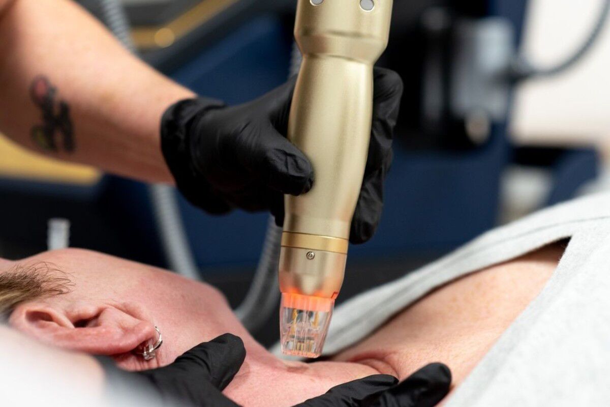 Hoe lang duurt het voordat littekens verbeteren na RF-microneedling ...